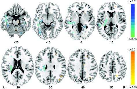 Tract Based Spatial Statistics Tbss Analysis Of Acute Imaging Download Scientific Diagram