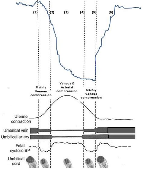 Truthful Pathophysiological Cord Compression Deceleration Schematic