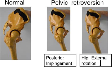 Adult Spinal Deformity And Its Relationship With Hip Range Of Motion A