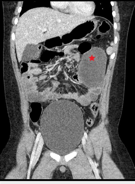 Figure 2 From A Case Report Of Axial Torsion Of Meckels Diverticulum