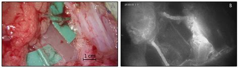 Popliteal Vascular Lymph Node Resection In The Rabbit Hindlimb For Secondary Lymphedema