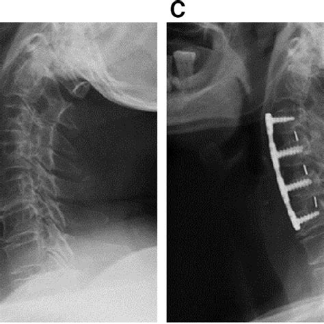 Male 69 Year Old Underwent Three Level Anterior Cervical Discectomy Download Scientific