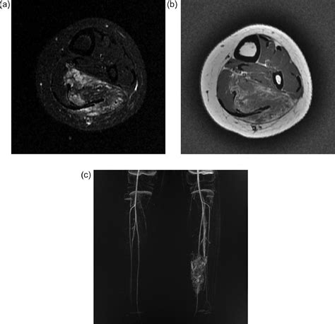 Brief Description Of Issva Classification For Radiologists Techniques In Vascular