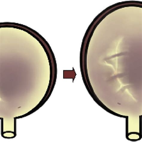 Incision Of Bladder Scar With Holmium Laser Note The Exposure Of Download Scientific Diagram