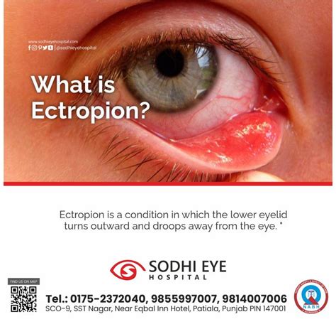 Ectropion Is A Condition In Which The Lower Eyelid Turns Outward And