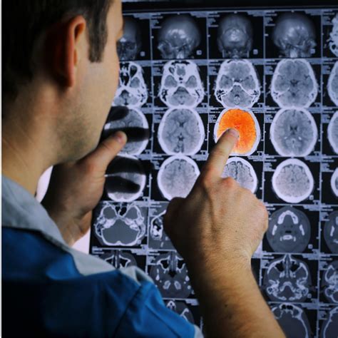 Role Of Micro Emboli Detection In The Management Of Ischaemic Stroke