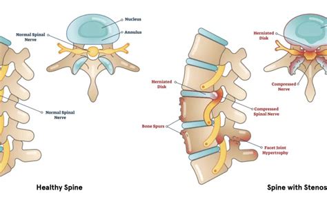 Spinal Stenosis Archives Spine Info