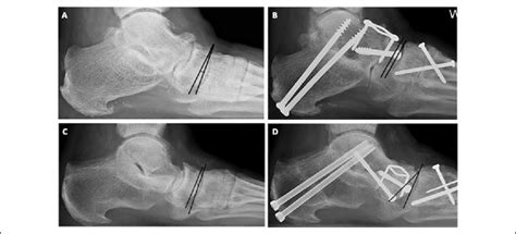 Navicular Cuneiform Incongruency Angle Ncia Radiographic Measurement Download Scientific