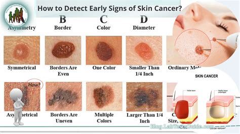 How To Detect Early Signs Of Skin Cancer Lab Tests Guide Blog