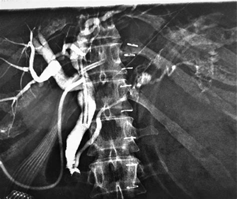 Cholangiogram Through The T Tube Showing The Out Of The Ordinary Source