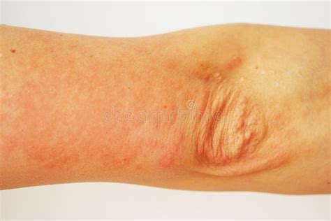 Red Pustules And Vesicles On The Skin Of The Hand As Symptoms Of Photodermatitis Allergic