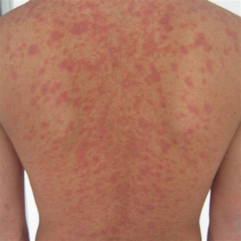 Erythematous Plaque On Lower Lip In A Case Of Systemic Lupus Erythematosus Download