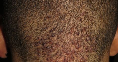 Dermapixel Granos En La Nuca
