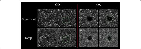 Foveal Avascular Zone Extraction In Superficial Capillary Plexus Scp