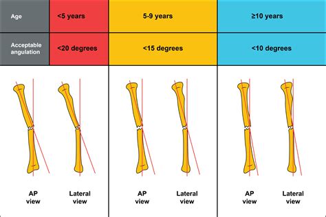 Midshaft Radius And Ulna Fractures Dont Forget The Bubbles