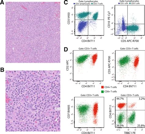 A B Histological Sections Show Complete Effacement Of The Lymph Node Download Scientific