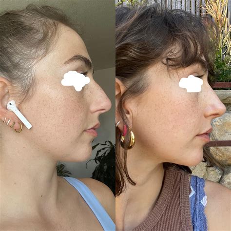 Lets Get Real About Post Rhinoplasty Recovery Rplasticsurgery