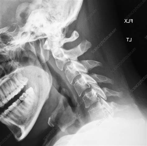 Normal Cervical Spine X Ray Stock Image C039 3922 Science Photo Library