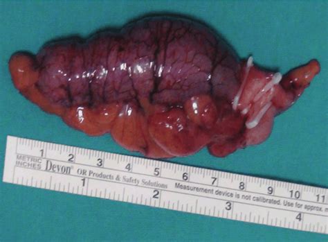 Gross Appearance Of The Resected Appendix Download Scientific Diagram