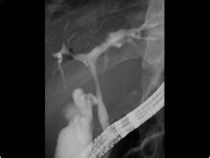 Abdomen And Retroperitoneum 1 2 Gallbladder And Bile Ducts Case 1 2 18 Bile Duct