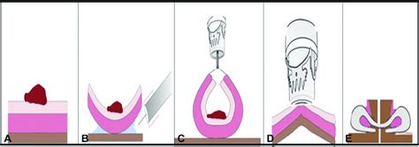 Schematic Illustration Of The Hybrid Endoscopic Submucosal Download Scientific Diagram