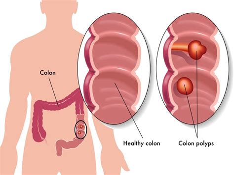 How Your Hemorrhoids Can Save Your Life