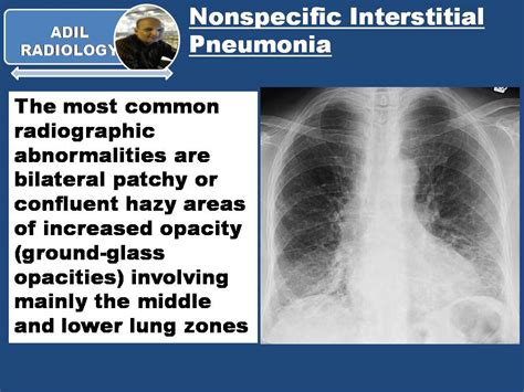 Nonspecific Interstitial Pneumonia Radiology Classroom