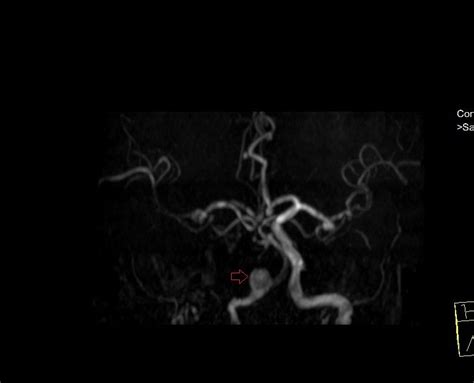 Cerebral Aneurysm Berry Aneurysms Mri Radiology Article On Saccular