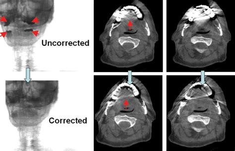 Reducing Metal Artifacts In Cone Beam Ct Images By Preprocessing Projection Data International
