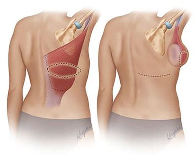 Latissimus Dorsi Flap Reconstruction Technique