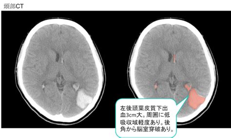 脳動静脈奇形avmとは？mri画像診断のポイントは？