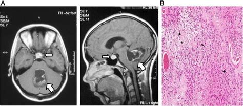 Hyperprolactinemia Concise Medical Knowledge