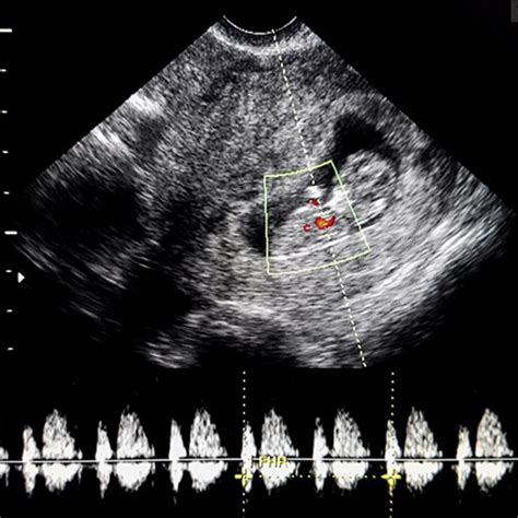 The Link Between Umbilical Cord Variables And Gestational Age In Normal