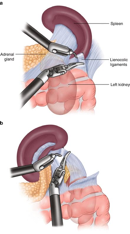 Robot Assisted Total And Partial Adrenalectomy Abdominal Key
