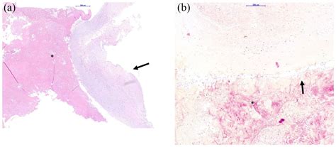 Systemic Embolization Due To Non Bacterial Thrombotic Endocarditis An
