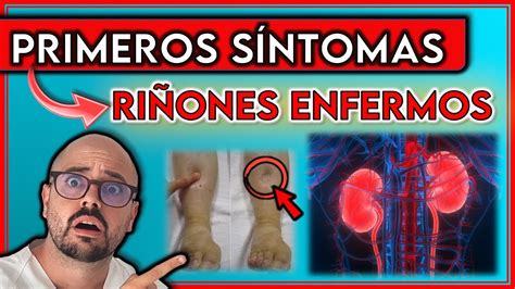 Estos Son Los 9 Primeros SÍntomas De Unos RiÑones Enfermos Indican
