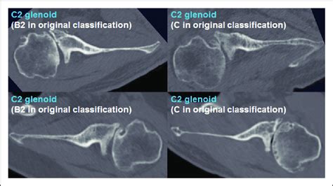 Ct Scan Examples Of 4 C2 Glenoids And Classification According To Download Scientific Diagram