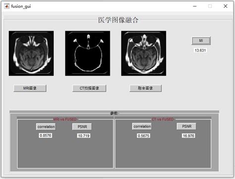 基于matlab医学图像融合gui界面 索炜达猿创 基于matlab医学图像融合gui界面 索炜达猿创