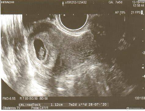 7 недель беременности что происходит с малышом и мамой размер плода фото узи