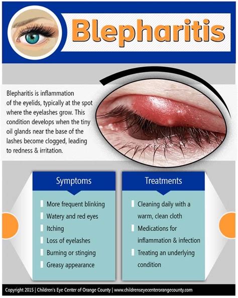 Blefaritis Adalah Radang Pada Kelopak Eye Nur Optometry