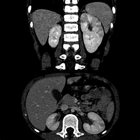 School Ager With Meatal Stenosis And Abdominal Pain And Fever