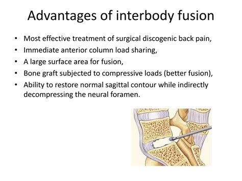 Fusion With Open Or Minimally Invasive Techniques In Degenerative