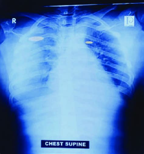 Cxr On 7 Th Day Of Admission Download Scientific Diagram