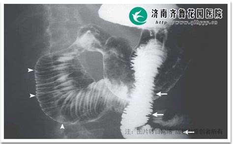 什么是上消化道钡餐造影检查 济南齐鲁花园医院