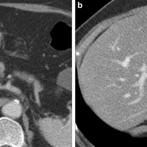 Gallbladder Volume Measurement On Abdominal Ct A Outlines Of Download Scientific Diagram