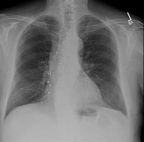 What Are Surgical Clips In An Xray At Joanne Magana Blog