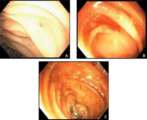 Photographs Taken During Intraoperative Enteroscopy Case 1