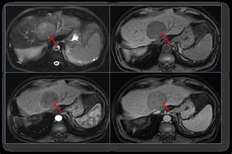 Figure 7 From Mri Ancillary Findings On Hcc Diagnosis Semantic Scholar
