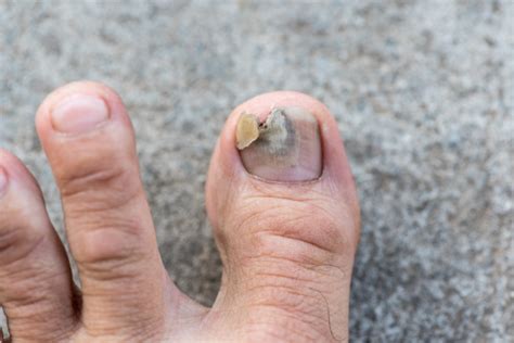 Preventing Toenail Fungus Tips For Healthy Feet