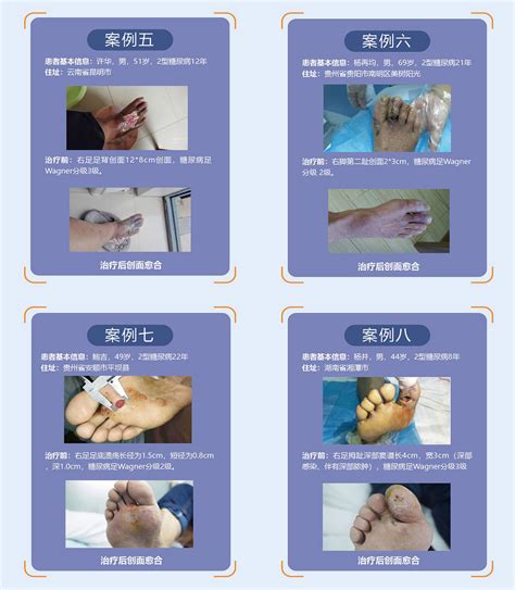 贵州百灵免费治疗糖尿病足 贵州百灵糖尿病公益诊疗计划 贵州百灵中医糖尿病医院